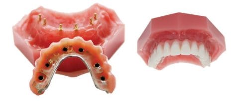 Mini Dental Implants - Shatkin Dental Health